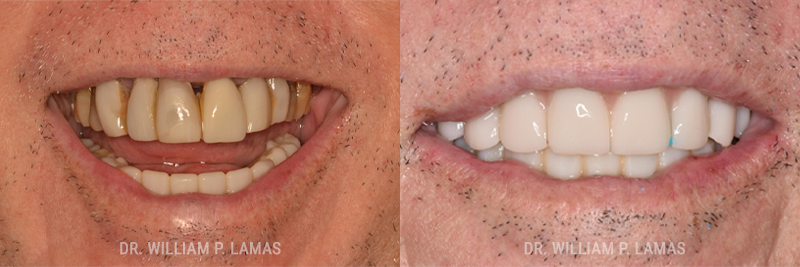Full Teeth Replacement Before & After Photos - Dr. William Lamas