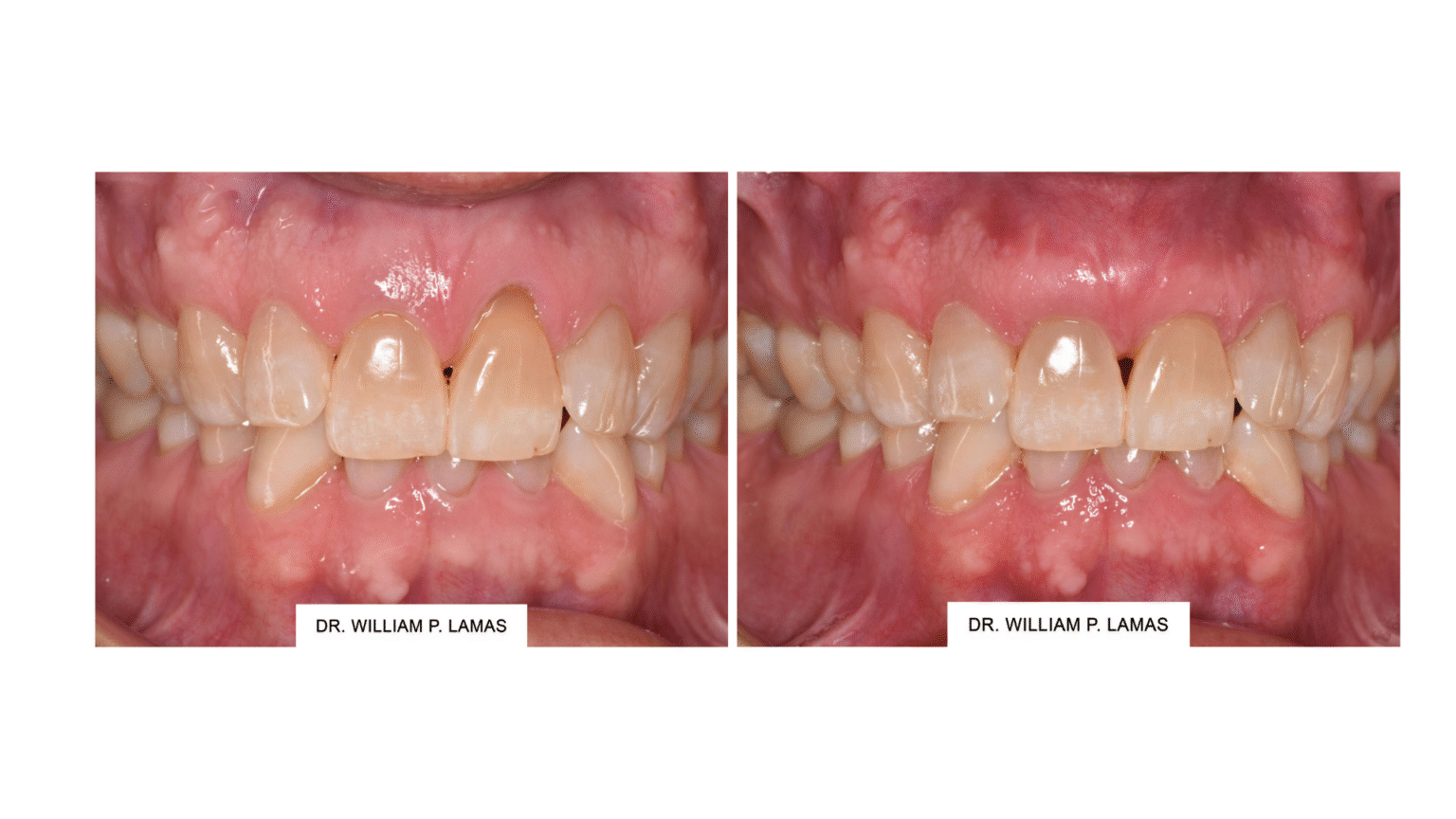 Gum Recession Treatment (Gum Grafting) Before & After Photos - Dr ...