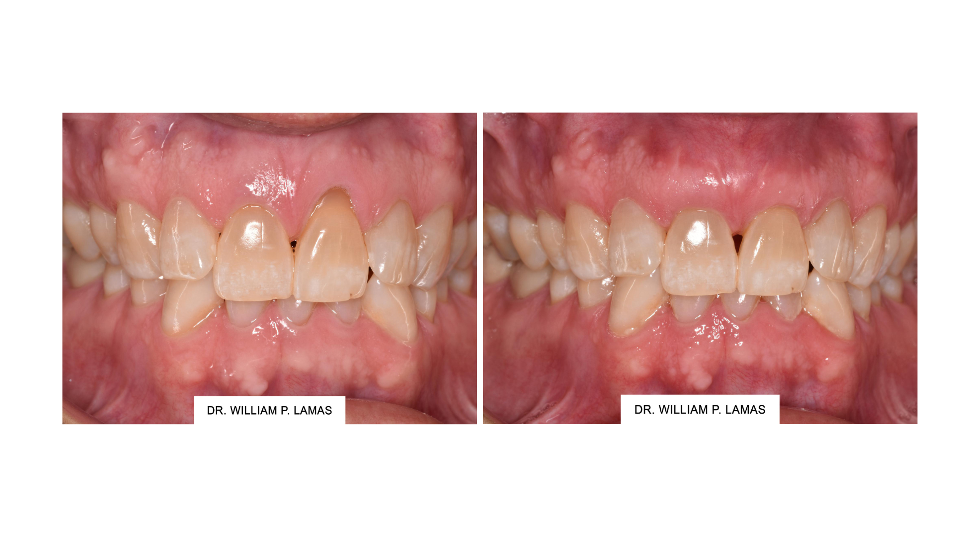 Gum Recession Treatment (Gum Grafting) Before & After Photos - Dr ...